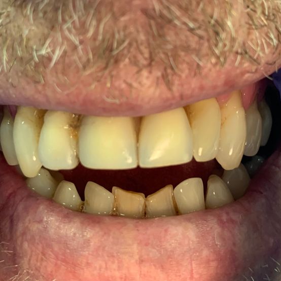 Before & After | Walkinstown Dental Studio | Dublin